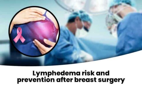 Lymphedema Risk And Prevention After Breast Surgery